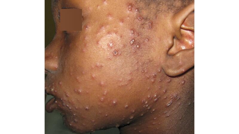Chickenpox: A Complete Guide to Symptoms, Spread, and More