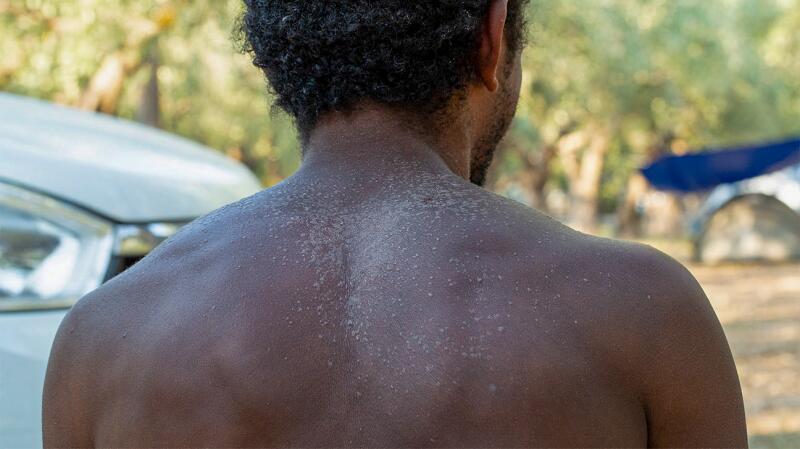 Sun Poisoning: Symptoms, Causes, Treatment, and More