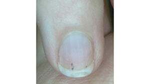 Kidney Disease and Nails: Possible Nail Symptoms