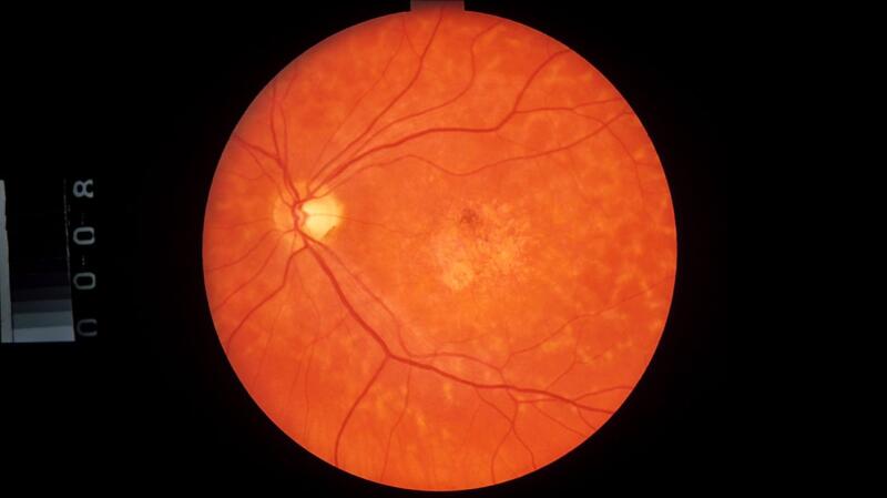 What Is Stargardt Disease? Symptoms, Causes, and Treatment