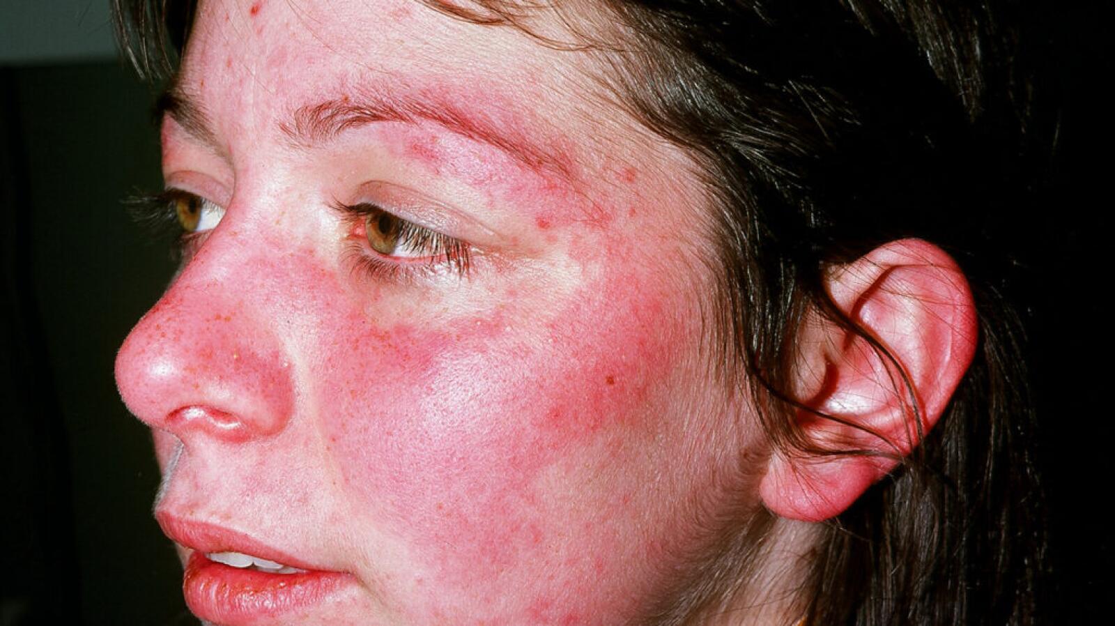 Red Nose: Causes and Treatments