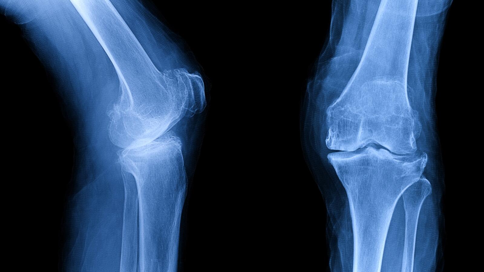 Arthritis: Definition, Types, Symptoms, and More