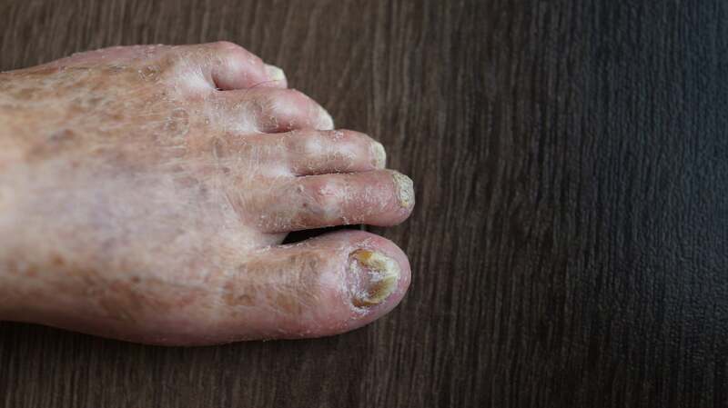 Toenail Discoloration: Causes, Related Symptoms, Treatments