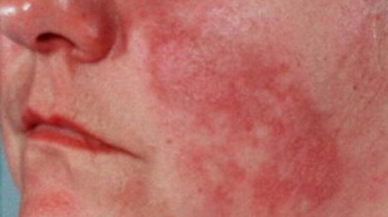 12 Symptoms of Lupus