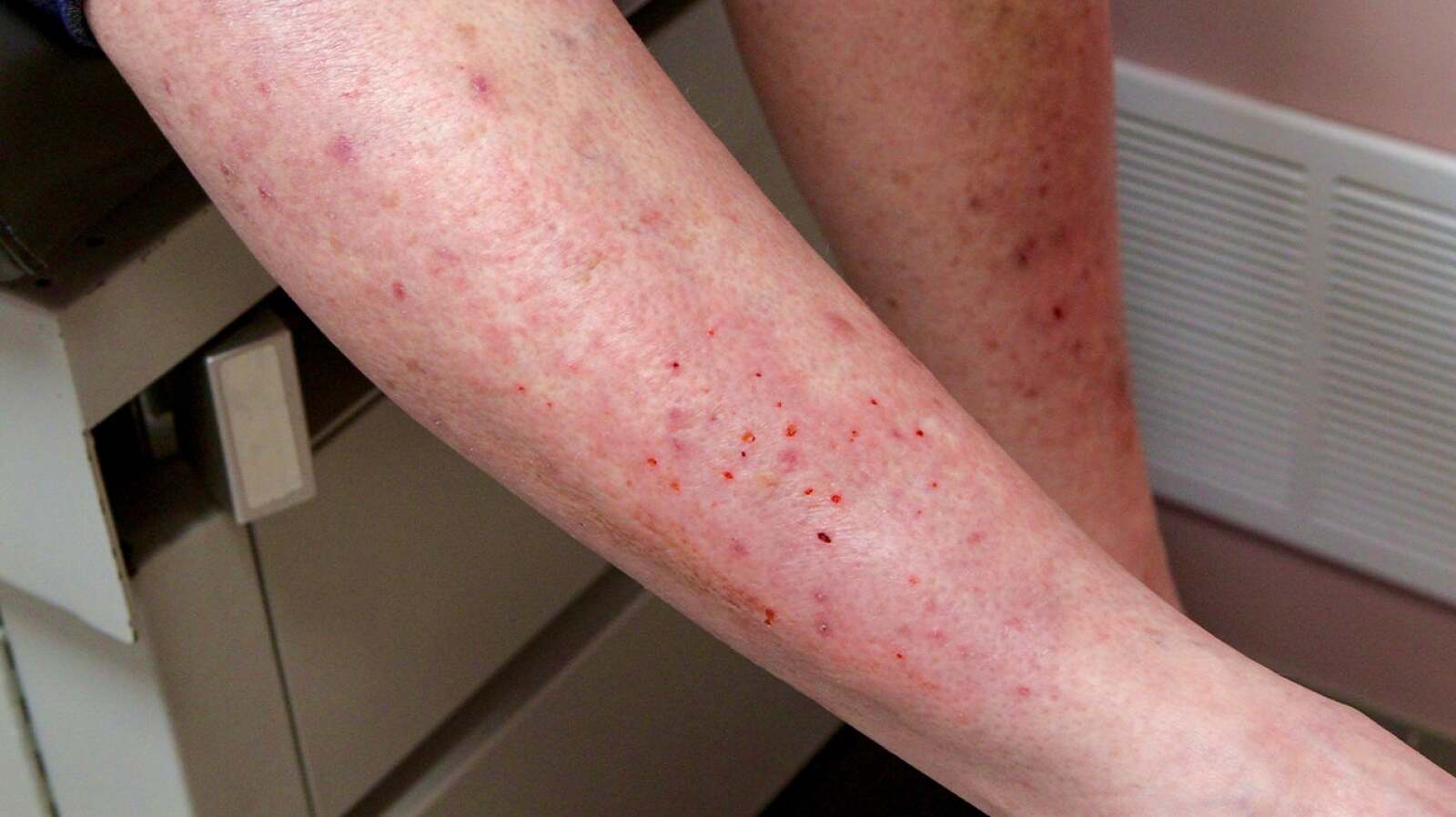 Atopic Dermatitis Vs Contact Dermatitis Whats The Difference