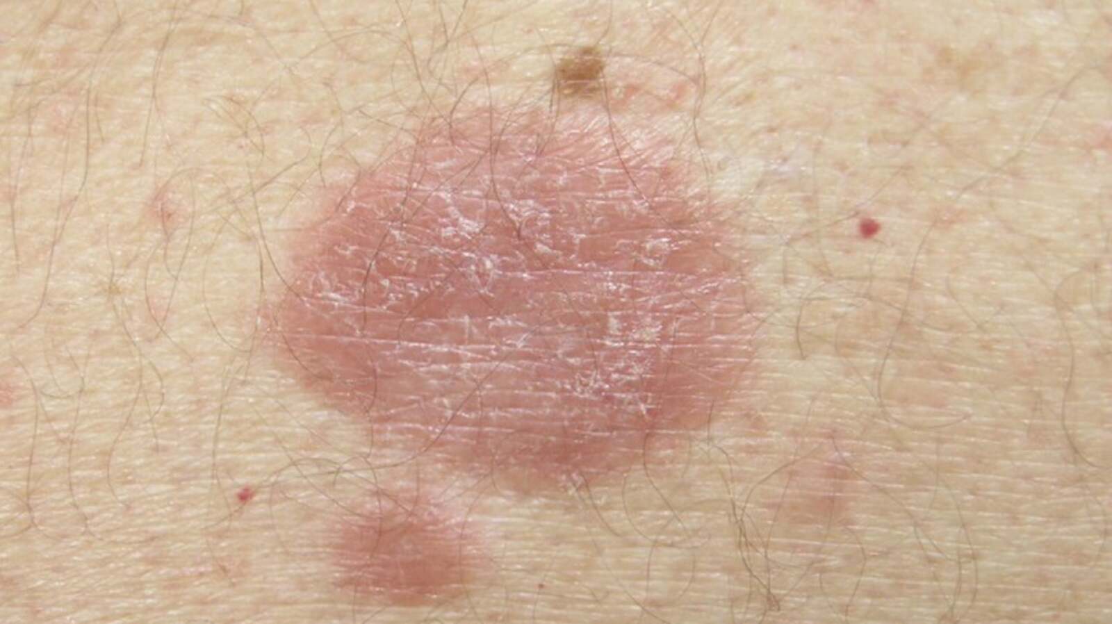 Skin Cancer Symptoms What To Look For And When To See A Doctor