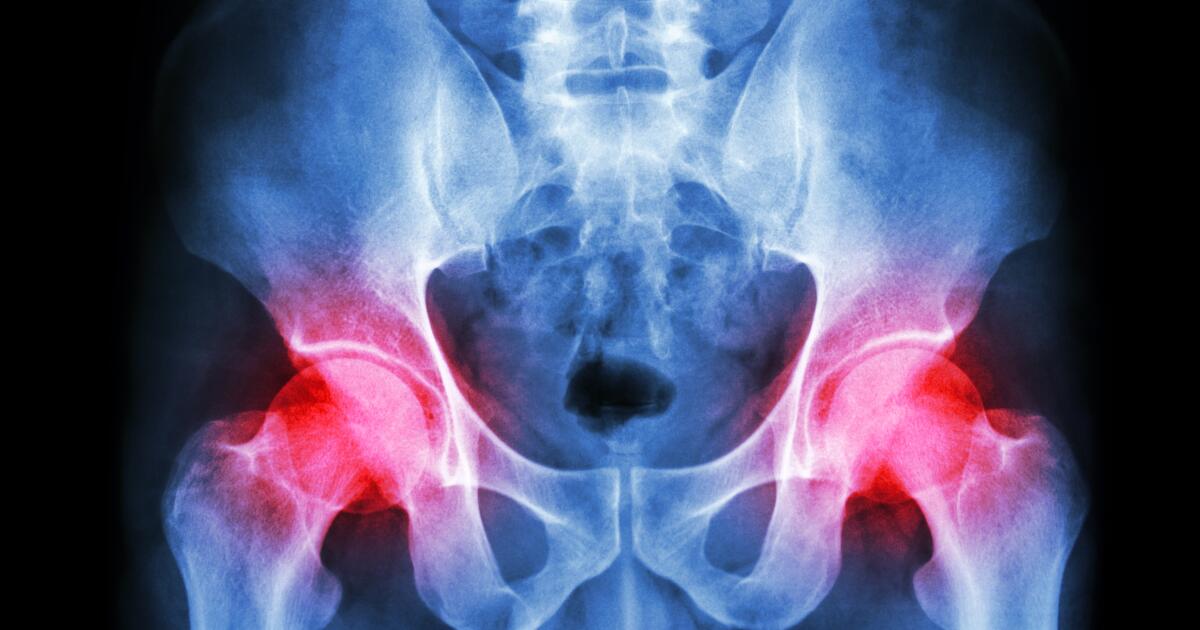 7 Things to Know About Bone Density Scans