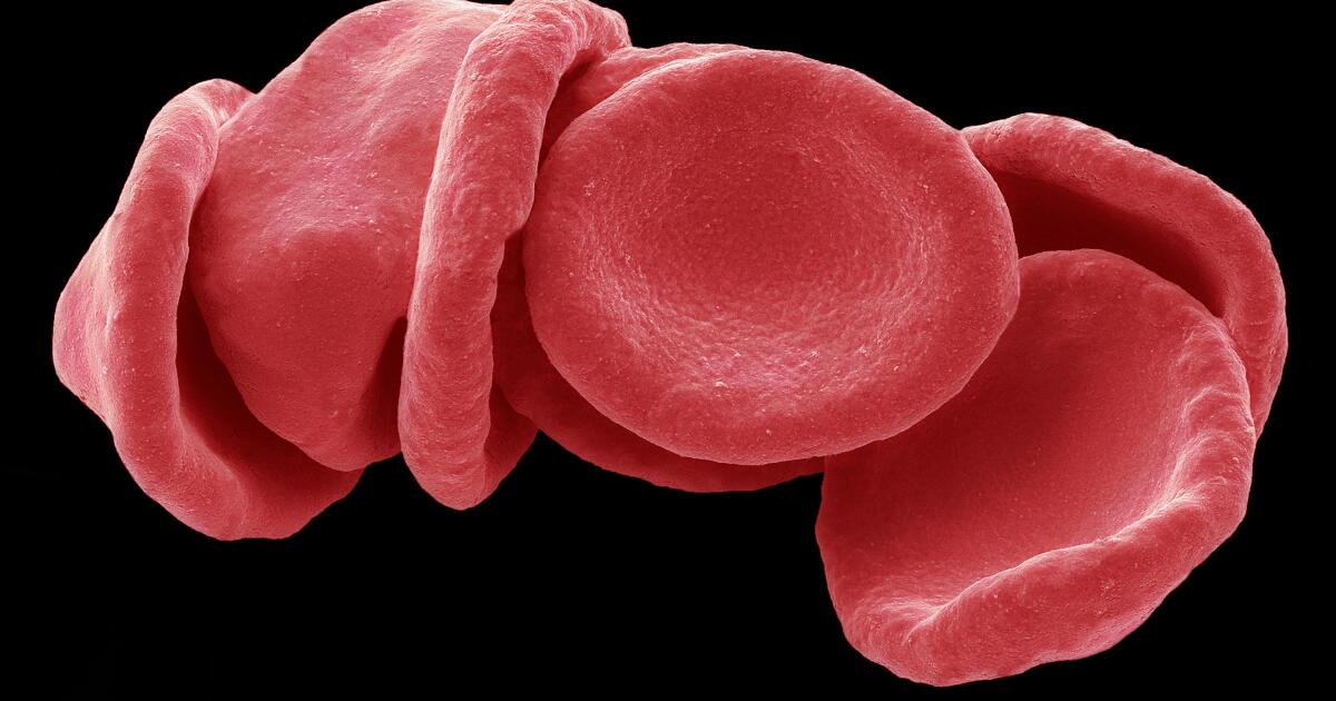 Septicemia - Symptoms, Causes, Treatments