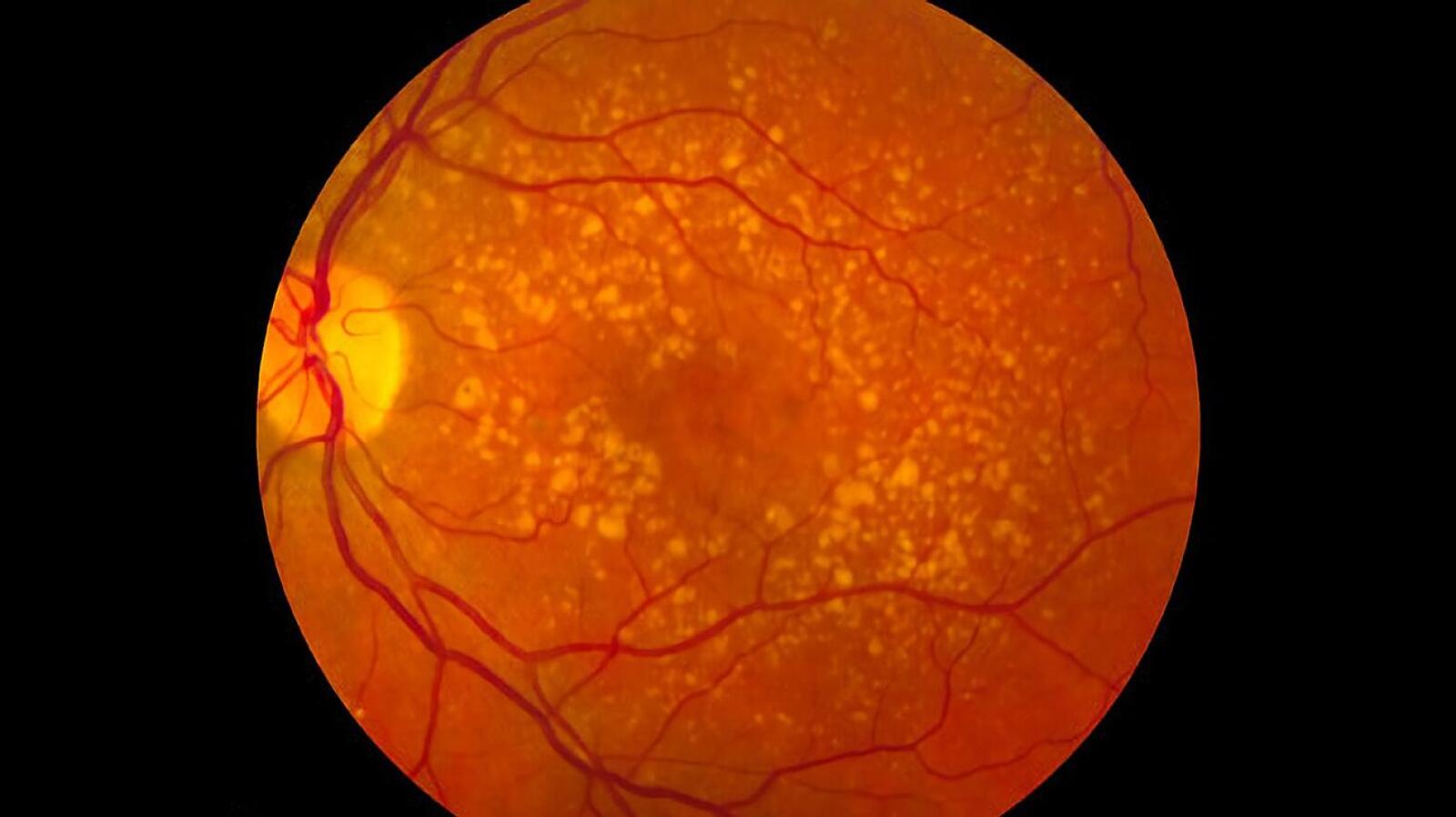 Stages of Macular Degeneration: Symptoms, Treatment, Outlook