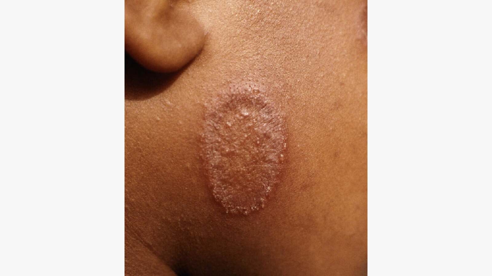 Ringworm vs. Eczema: Symptoms, Causes, Treatments