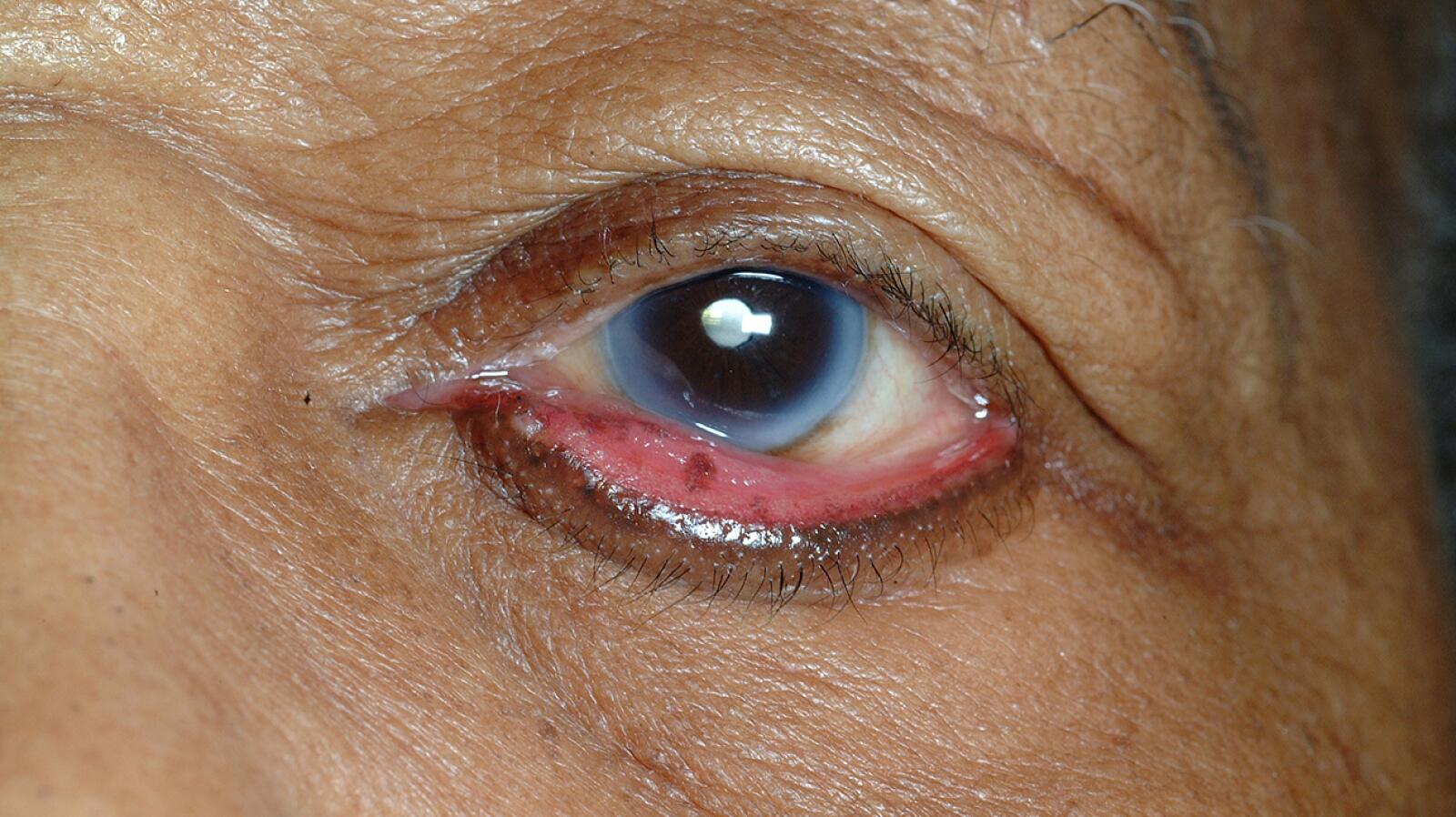 Ectropion: Symptoms, Causes, and Treatment