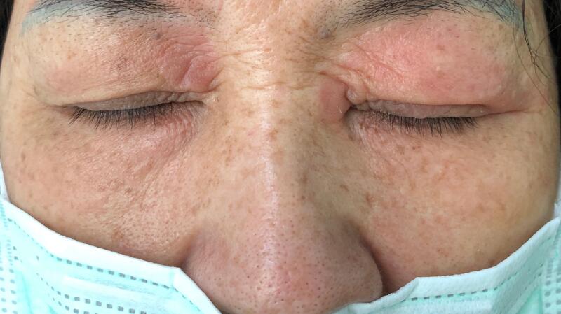 Eyelid Dermatitis: Treatments, Symptoms, Causes, and More