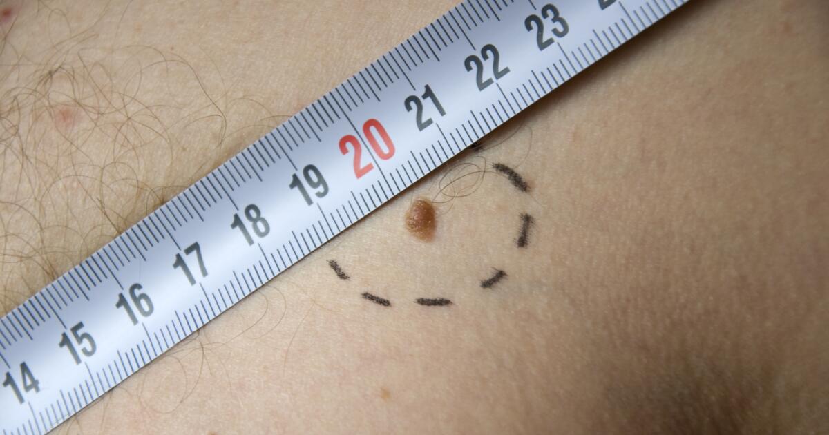 7 Things to Know About Advanced Melanoma