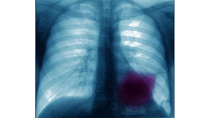 Real Lung Cancer Pictures, X-Rays, and Types