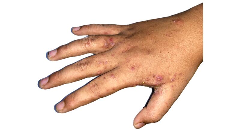 How to Identify Scabies: Symptoms, Pictures, Causes, and More