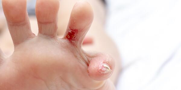 7 Types of Foot Rashes & How to Treat Them | Causes of Foot Rash