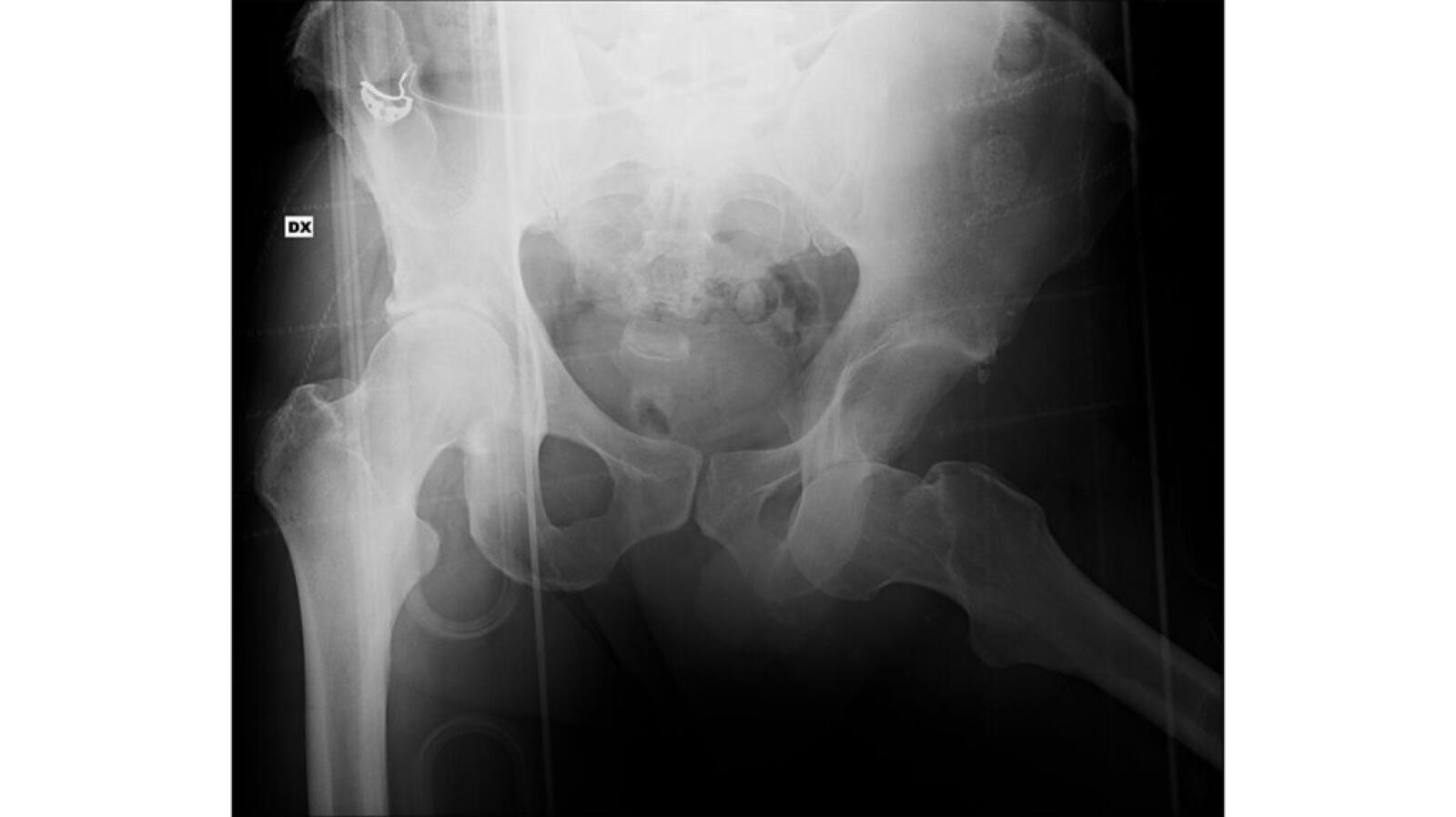 Hip Dislocation: Symptoms, Treatments, Causes, and More