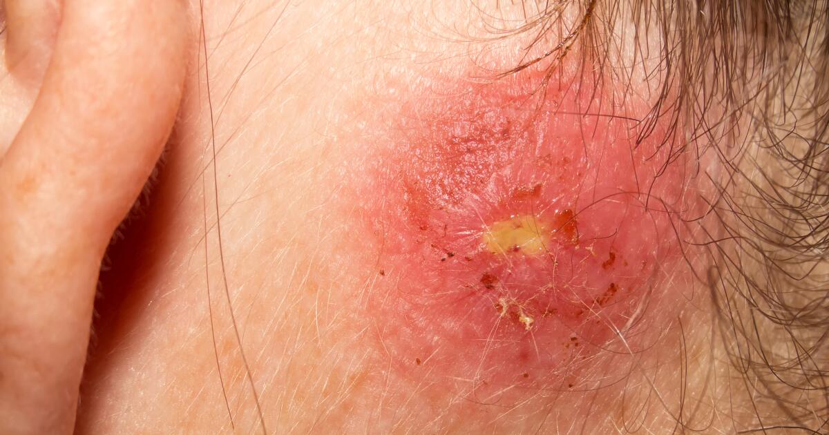 Cellulitis: Causes, Pictures & Treatment