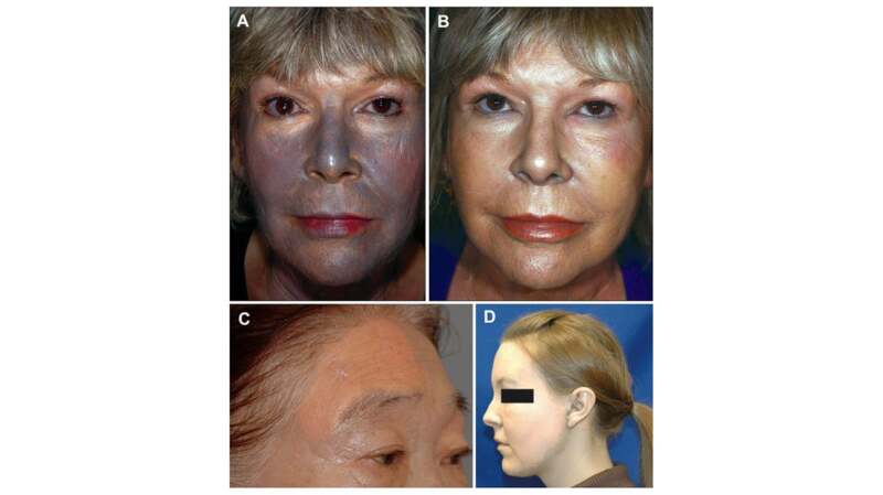 Argyria: Definition, Symptoms, Causes, Treatments, and More