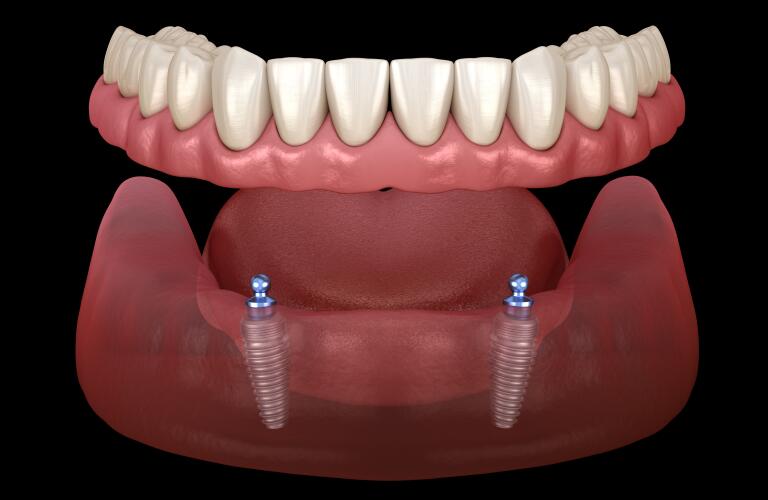 mandibular partial denture