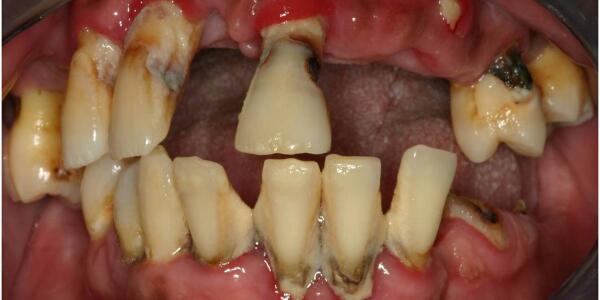 Mouth Cancer Pictures | What Oral Cancer Sores Look Like