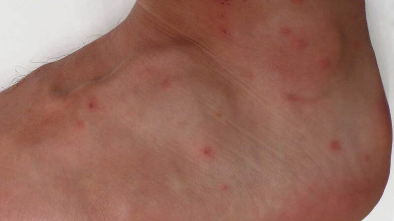 chigger bite uk