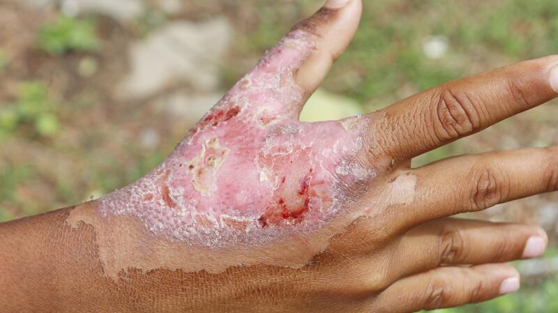 third degree burns on hands