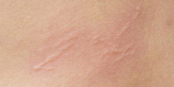 Itchiest Skin Conditions | What Skin Conditions Cause Itching?