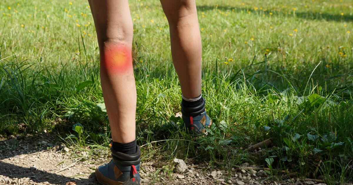 8 Surprising Cellulitis Facts | Is Cellulitis Contagious?