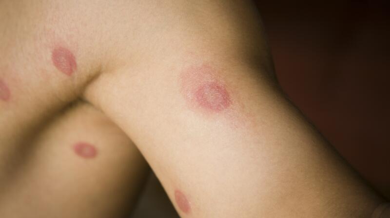 ringworm from insect bite