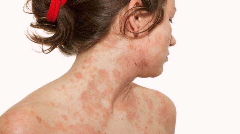Scabies or Eczema? Here Is How to Know