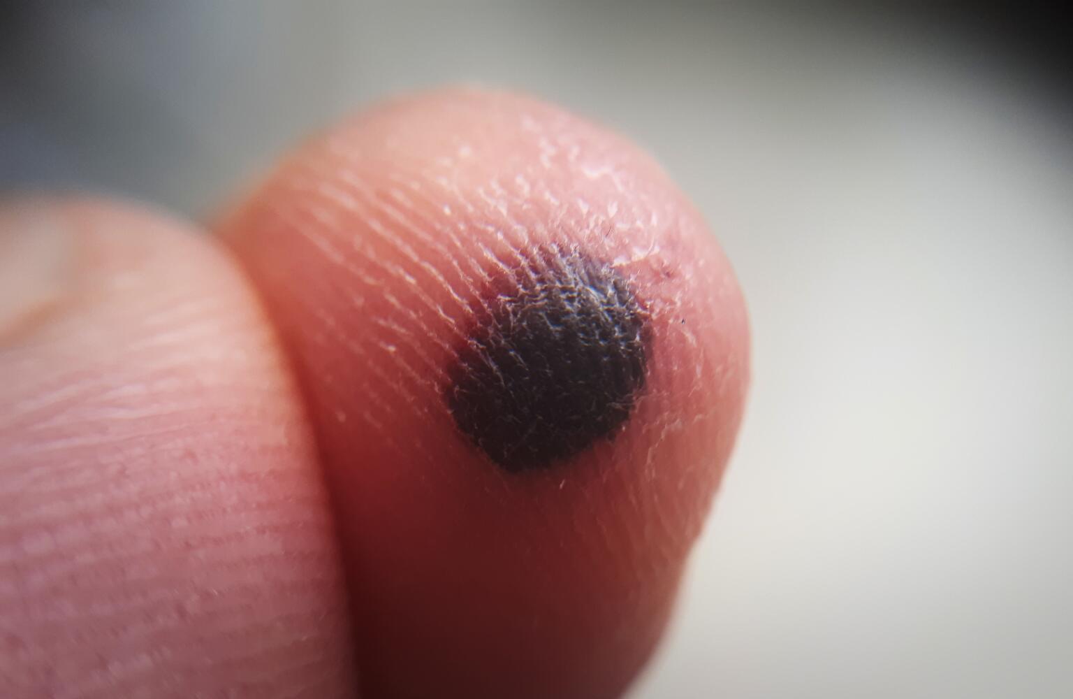 Blisters - Symptoms, Causes, Treatments