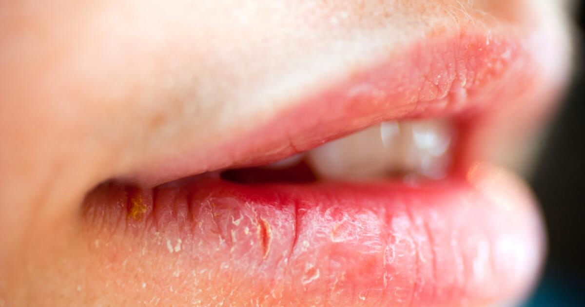 Cracked Lips - Symptoms, Causes, Treatments