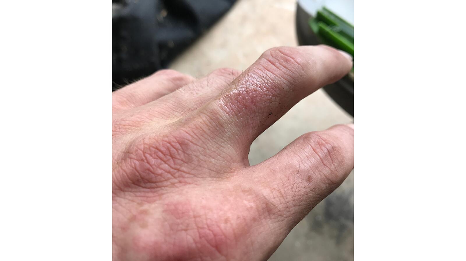 Black Widow Bites: Identifying Bites, First Aid, Outlook, and More