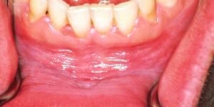 Mouth Cancer Pictures | What Oral Cancer Sores Look Like